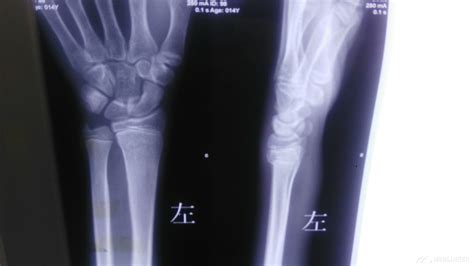 儿童的桡骨远端骨折。