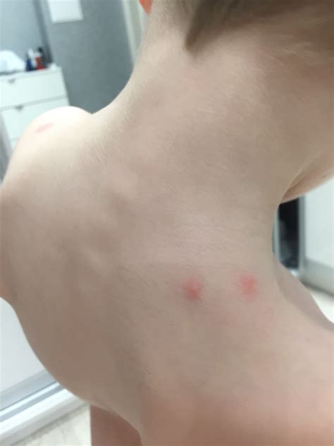 Сыпь укусы и волдыри Вопрос дерматологу 03 Онлайн