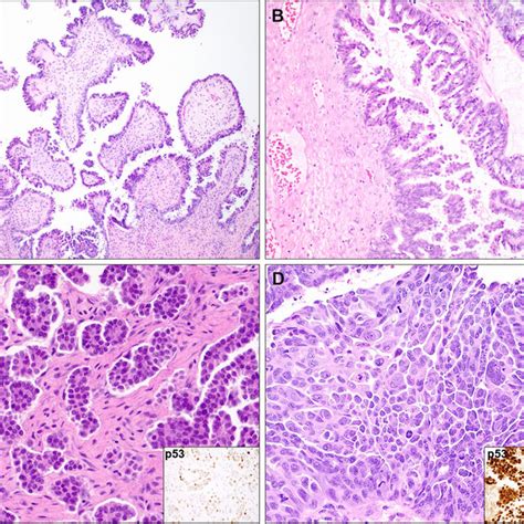 Histopathologic Spectrum Of Ovarian Serous Tumors A Serous Borderline Download Scientific