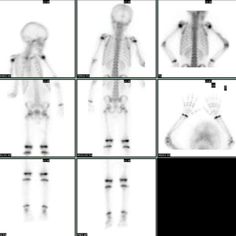 Tc99 Bone Scan With Tc99 Obtained At 2 Years And 4 Months Of Age Download Scientific