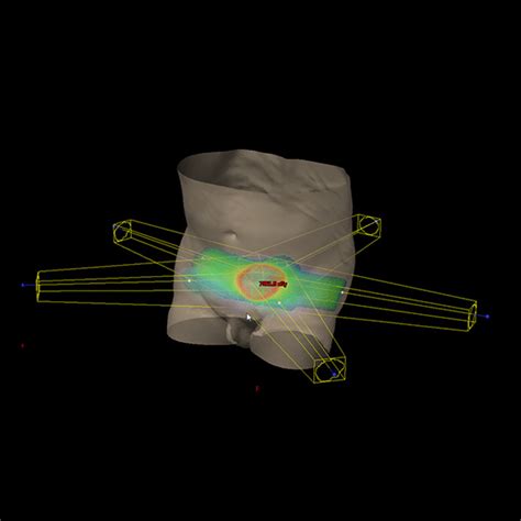 3d Radioterapia Tridimensional Conformada Mevaterapia Oncología