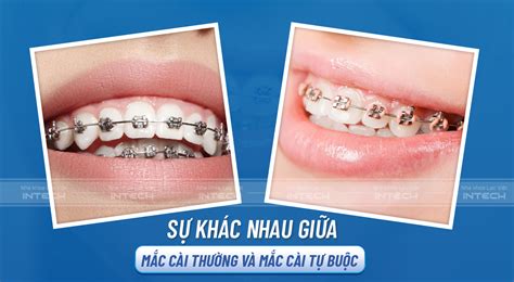 So Sánh Niềng Răng Mắc Cài Kim Loại Thường Và Mắc Cài Tự Buộc