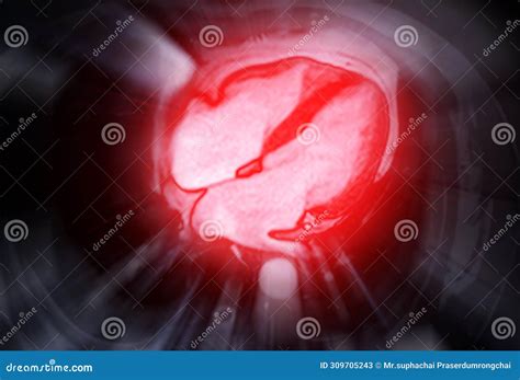Cardiac Mri Images Are Instrumental In Assessing Cardiac Health Identifying Heart Abnormalities