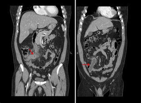 Appendiceal Mucocele In A 57 Year Old Male With Abdominal Distension Download Scientific