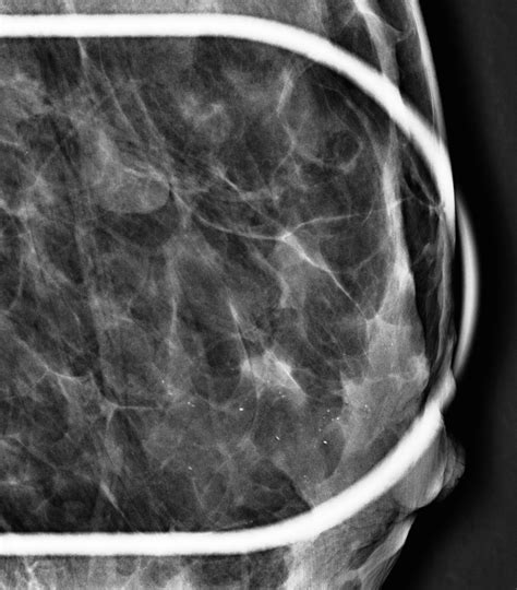 Paneth Cell Metaplasia