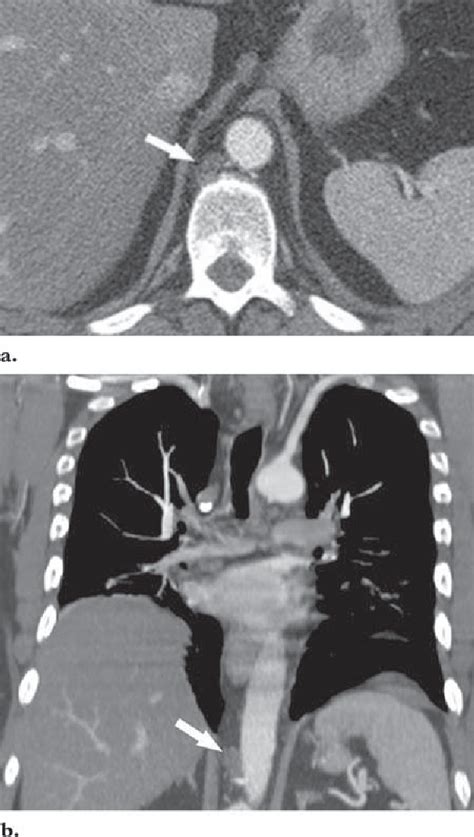 Figure 6 From The Diaphragmatic Crura And Retrocrural Space Normal