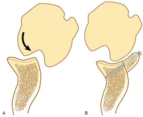 Coracoid Transfer The Open Latarjet Procedure For The Treatment Of Recurrent Anterior Inferior