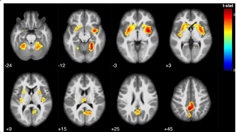 Statistical Parametric Map Showing Brain Regions Positively Correlated Download Scientific