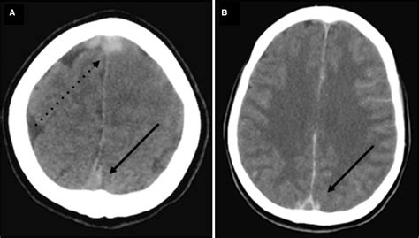 Cerebral Venous Sinus Thrombosis Journal Of Thrombosis And Haemostasis