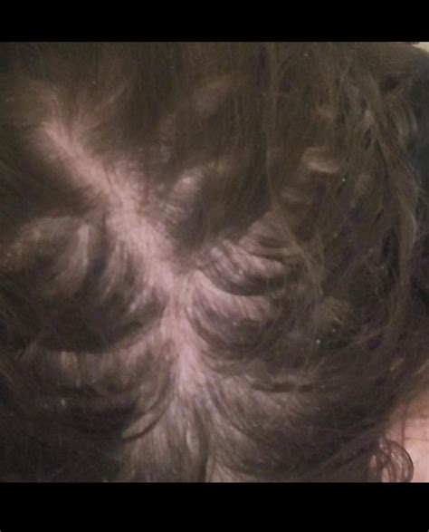 Is This Balding Or Diffuse Hair Loss 20f Rbalding