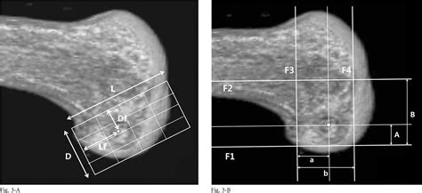 Figure 3 From Anatomic Single Bundle Acl Reconstruction Is Possible With Use Of The Modified