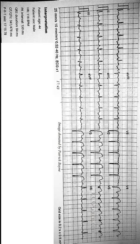 Onset Of Pathological Q Waves Ecg Guru Instructor Resources