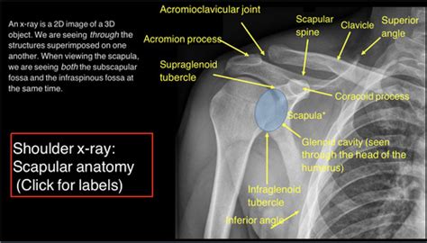 Ca 18 Imaging Of The Upper Extremity Flashcards Quizlet