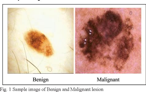 Figure 3 From Benign And Malignant Skin Lesion Detection From Melanoma