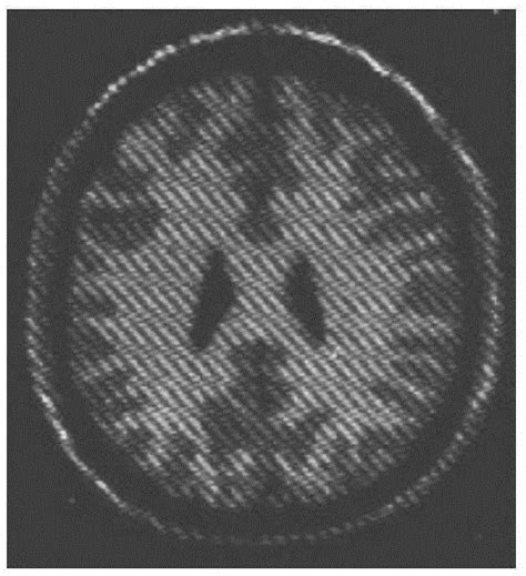 Small Target Mri Image Segmentation Method Of Minimum Cross Tsallis