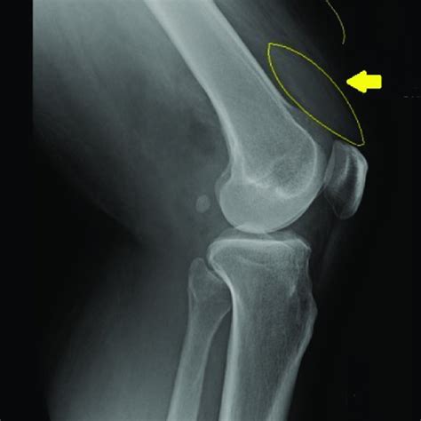Right Knee Radiograph With Joint Effusion Star And Soft Tissue