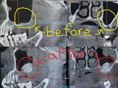 분당 미금역 수술 전문 구강외과 전문의 치과 찬스플란트치과 상악동 뼈이식 임플란트 언제 필요할까요 네이버 블로그