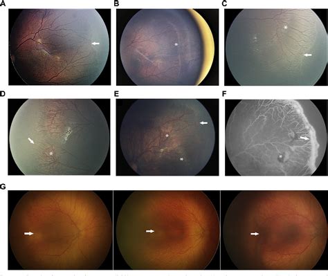 Figure 2 From International Classification Of Retinopathy Of Prematurity Third Edition