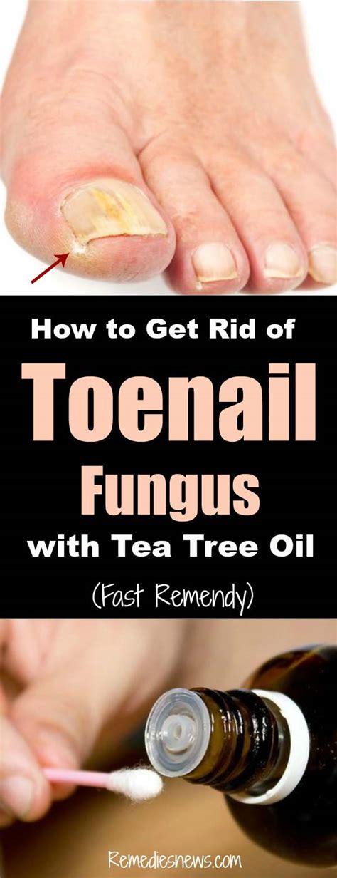 What Kills Nail Fungus Fast Nail Designs