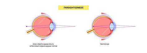 Premium Vector Normal Eye And Farsightedness