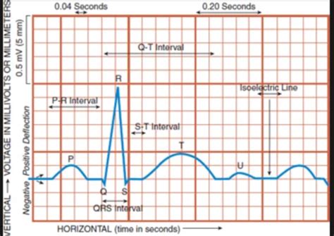 Arrythmias Conduction Ecg Flashcards Quizlet