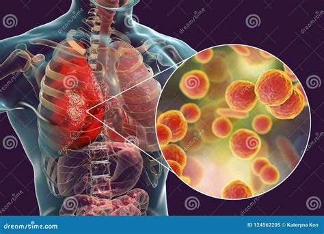 Bacterial Pneumonia Infection Bacterial Pneumonia Symptoms Causes