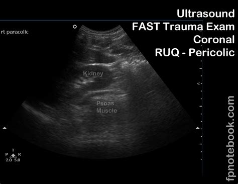 Right Intercostal Oblique Ultrasound View
