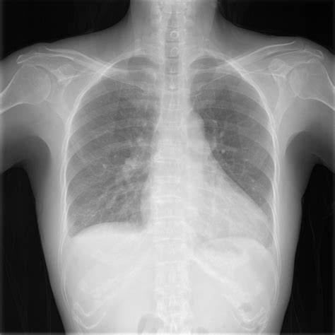 Python Pil Converting From I16 To Jpeg Produce White Image Stack Overflow