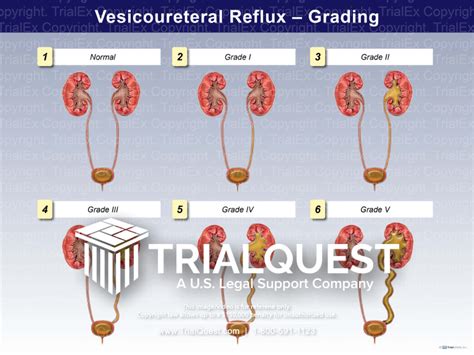 Vesicoureteral Reflux Grading Trialquest Inc