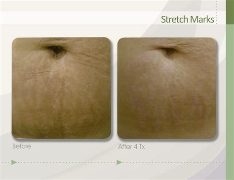 Celebrities With Stretch Marks