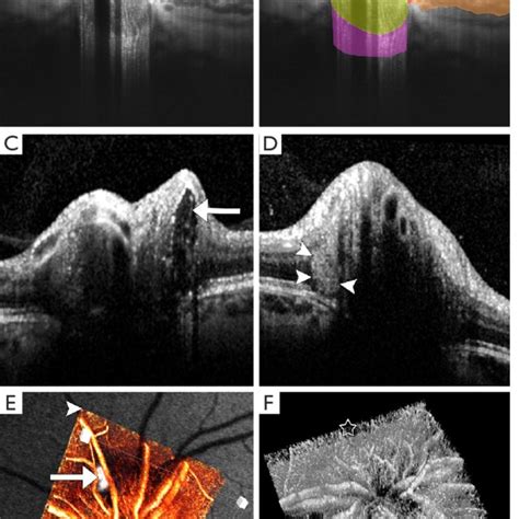 Oct Imaging Of A Normal Optic Disc And In A Case With Superficial Odd Download Scientific