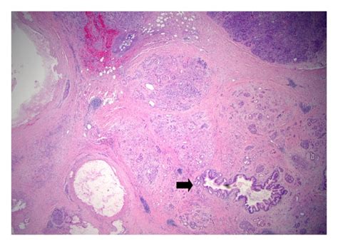 Atrophy Of Parenchyma Associated With IPMN The Acinar Parenchyma In Download Scientific