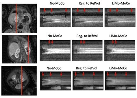 Linear Time Invariant Model Based Motion Compensation For Renal