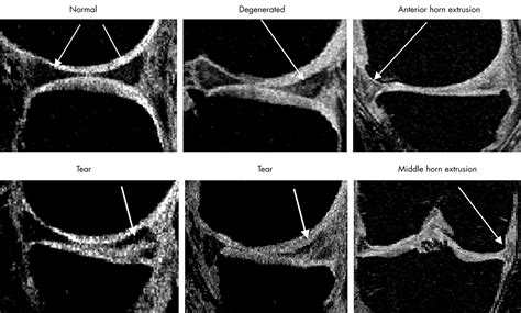 Medial Meniscus Tear Mri