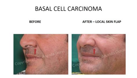 Before And After Cosmetic Surgery And Plastic Surgeon