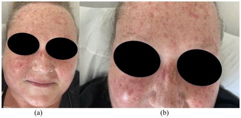 Clinical Photos Of Characteristic Lesions Several Erythematous Macules Download Scientific