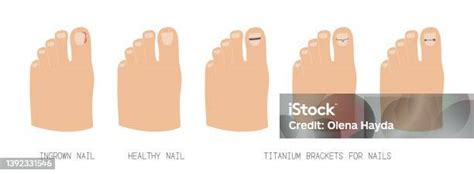 티타늄 브래킷 다른 유형으로 내향성 발톱 치료 손으로 그린 벡터 일러스트 레이 션 감입조에 대한 스톡 벡터 아트 및 기타 이미지 감입조 개선 건강 진단 Istock