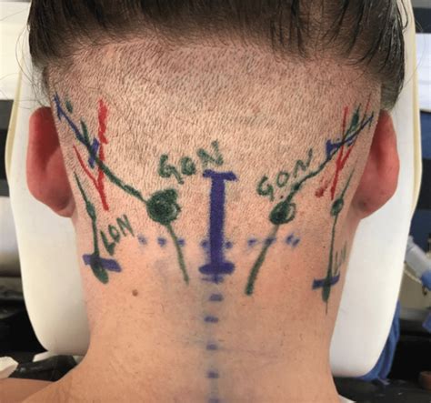 Endoscopic Nerve Decompression Surgery At Elfriede Kiernan Blog