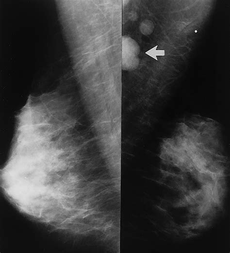 Focal Asymmetric Densities Seen At Mammography Us And Pathologic
