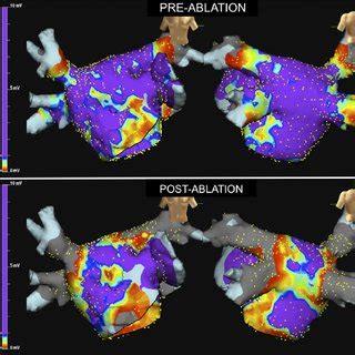 Voltage Maps Pre And Postablation Baseline A And Postablation B