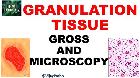 Granulation Tissue Pathology Gross And Microscopy Illustration Draw With Me Youtube