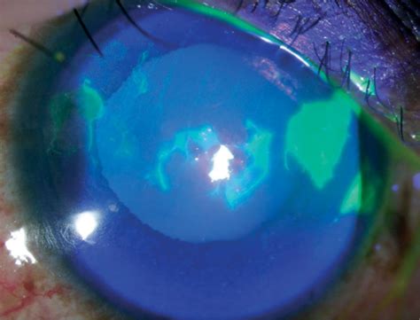 Corneal Abrasions Erosion And Ulcers Concise Medical Knowledge
