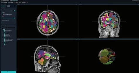 Fda Clears Emerging Ai Software For Brain Mri
