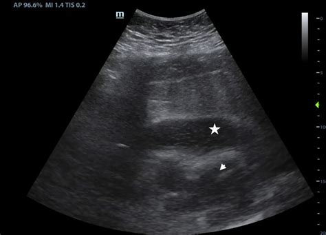 Subxiphoid Ultrasonography Of The Heart Showing Pericardial Effusion Download Scientific