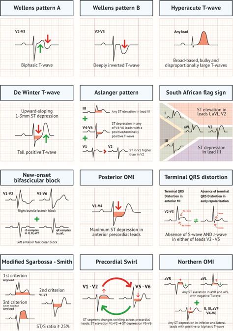 Critical Care Reviews On Linkedin Ecg Patterns Of Occlusion Myocardial Infarction A Narrative