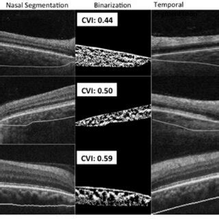Top Row Panel OCT Scan Nasal Segmentation Of OCT Scan Binarization