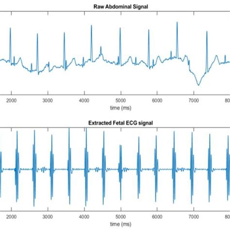 Representing The Raw Abdominal Signal And The Finally Obtained Fetal Ecg Download Scientific