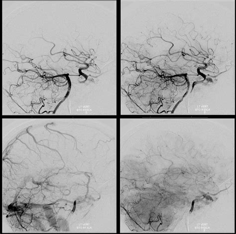 Balloon Test Occlusion
