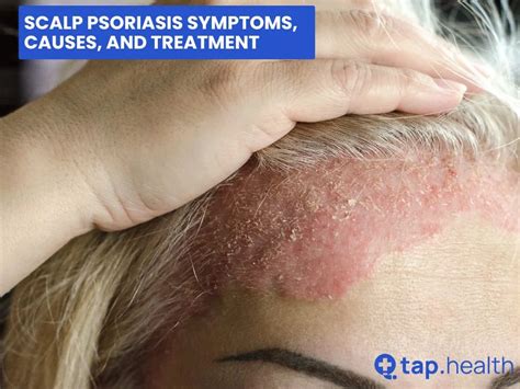 Scalp Psoriasis Symptoms Causes And Treatment Tap Health