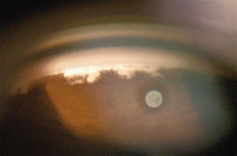 Anterior Synechiae